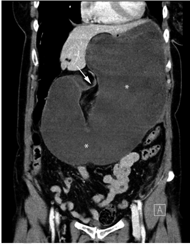 Paraesophageal Hernia With Gastric Volvulus