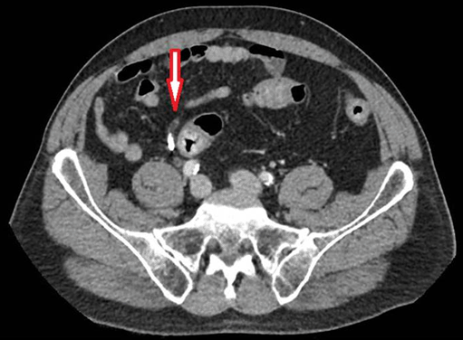 FULL TEXT - Barium-induced allergic appendicitis: A case report ...